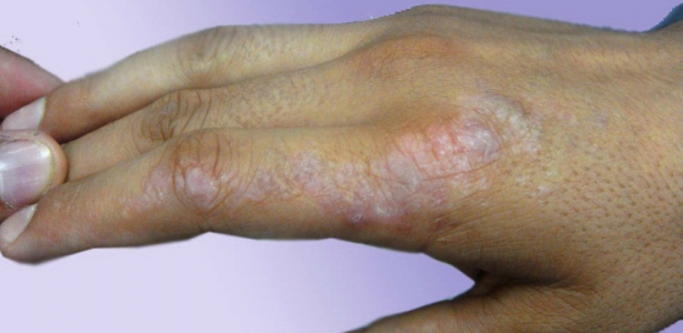 Linear Lichen Planus